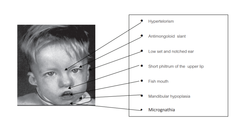 digeorge syndrome โรคที่เกิดจากโครโมโซมคู่ที่ 22q11.2 ขาดหายไป ...